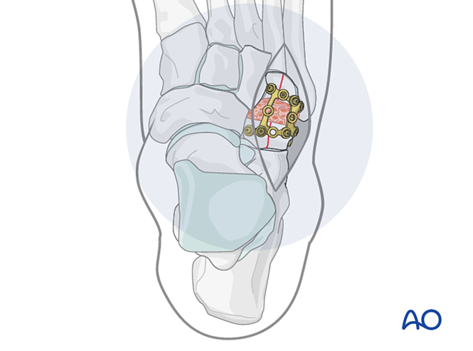 Plate fixation for Multifragmentary cuboid fracture