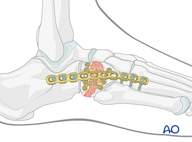 Plate fixation for Multifragmentary cuboid fracture