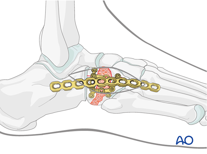 Plate fixation for Multifragmentary cuboid fracture