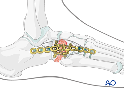 Plate fixation for Multifragmentary cuboid fracture