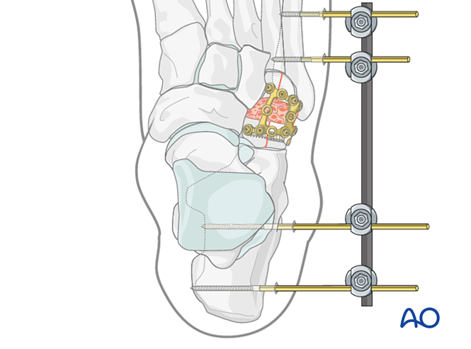 Plate fixation for Multifragmentary cuboid fracture