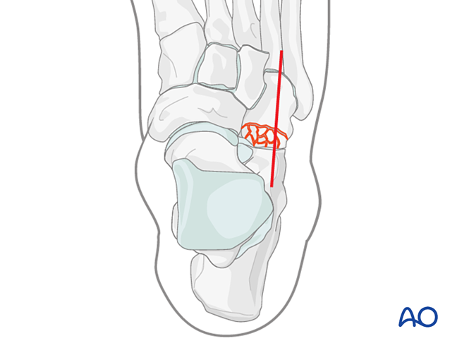 Primary fusion of unreconstructable calcaneocuboid joint