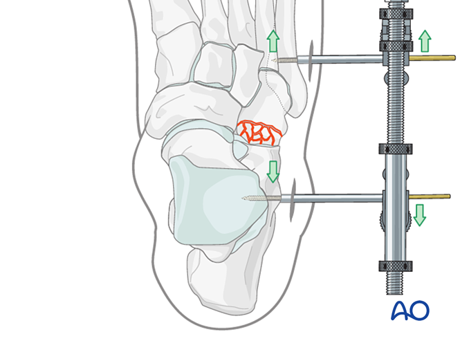Primary fusion of unreconstructable calcaneocuboid joint