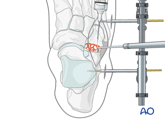 Primary fusion of unreconstructable calcaneocuboid joint
