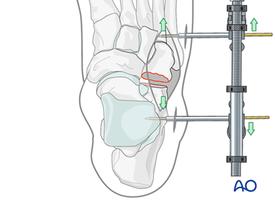 Primary fusion of unreconstructable calcaneocuboid joint