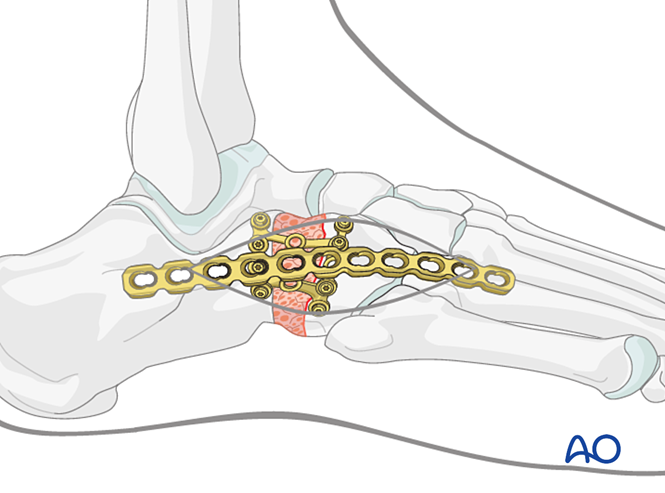 Primary fusion of unreconstructable calcaneocuboid joint