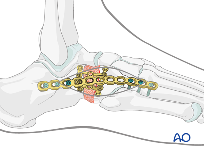 Primary fusion of unreconstructable calcaneocuboid joint