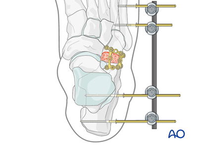 Primary fusion of unreconstructable calcaneocuboid joint