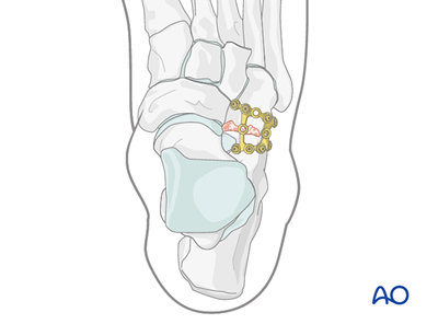 Primary fusion of unreconstructable calcaneocuboid joint