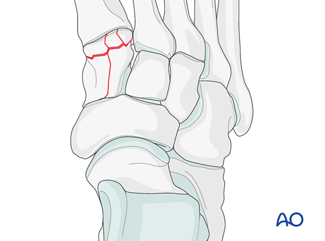 Cuneiform fractures
