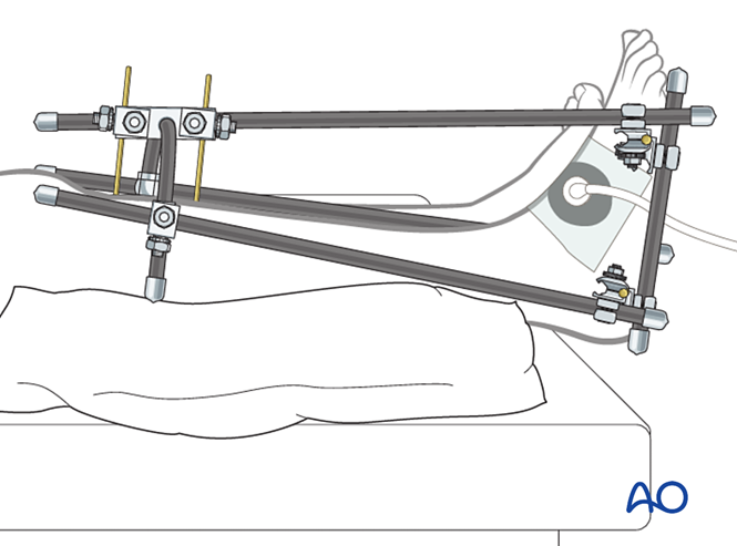 External fixation for Intertarsal crush injury