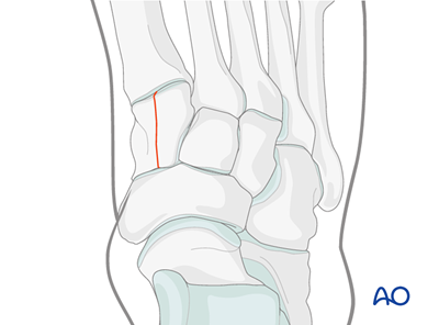 Lag-screw fixation for Cuneiform fracture