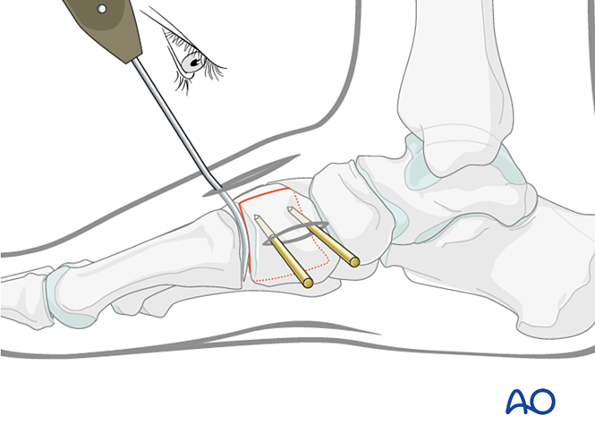 Lag-screw fixation for Cuneiform fracture