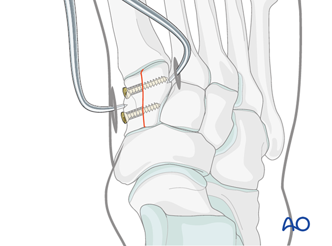 Lag-screw fixation for Cuneiform fracture