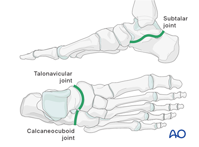 Plate fixation for Cuneiform fracture