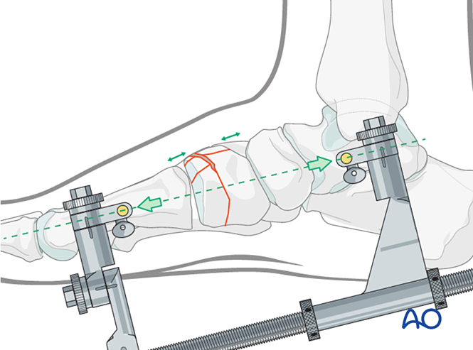 Plate fixation for Cuneiform fracture