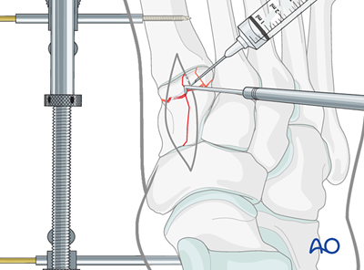 Plate fixation for Cuneiform fracture