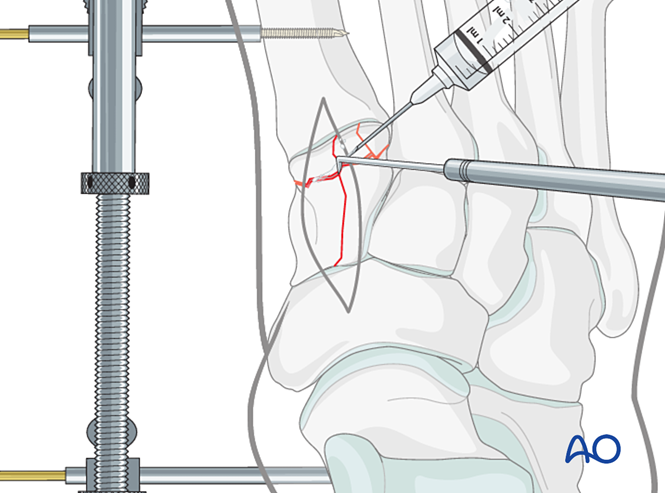 Plate fixation for Cuneiform fracture
