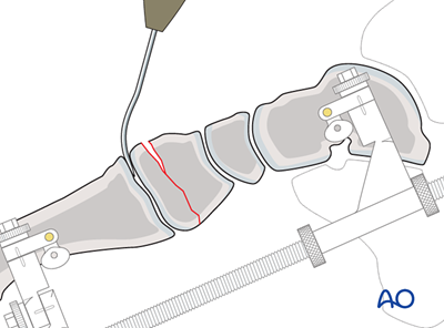 Plate fixation for Cuneiform fracture