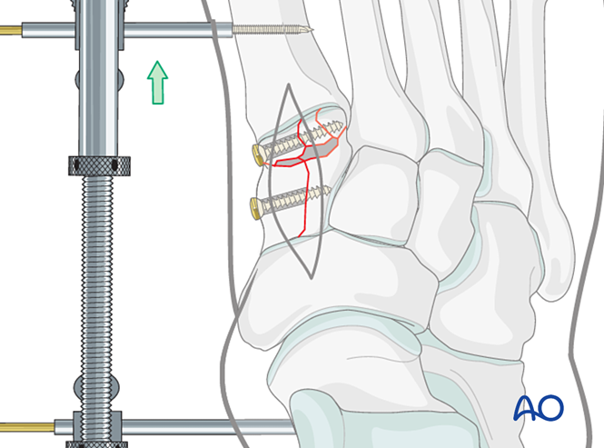 Plate fixation for Cuneiform fracture