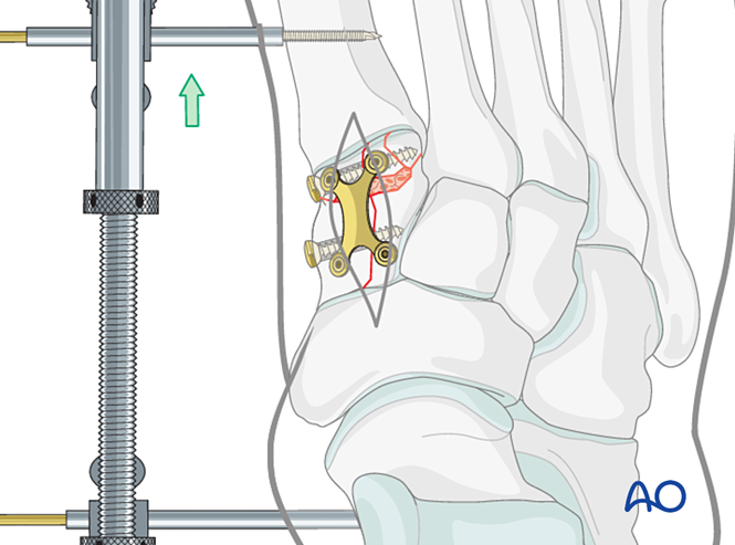 Plate fixation for Cuneiform fracture