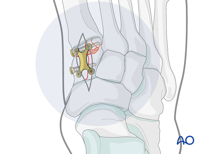 Plate fixation for Cuneiform fracture