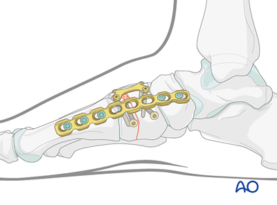 Plate fixation for Cuneiform fracture