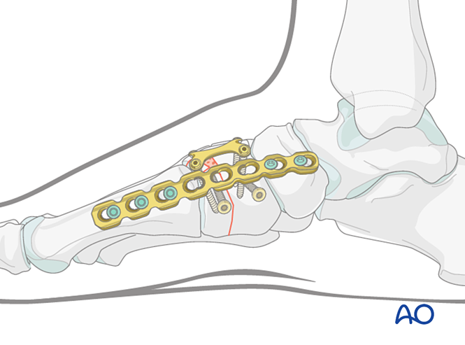 Plate fixation for Cuneiform fracture