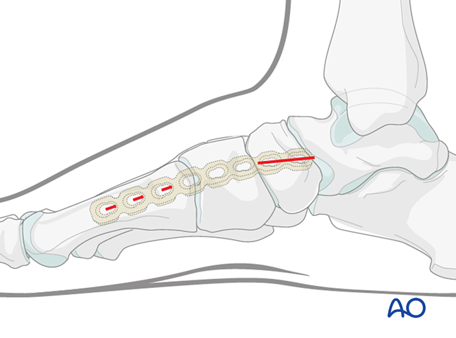 Plate fixation for Cuneiform fracture