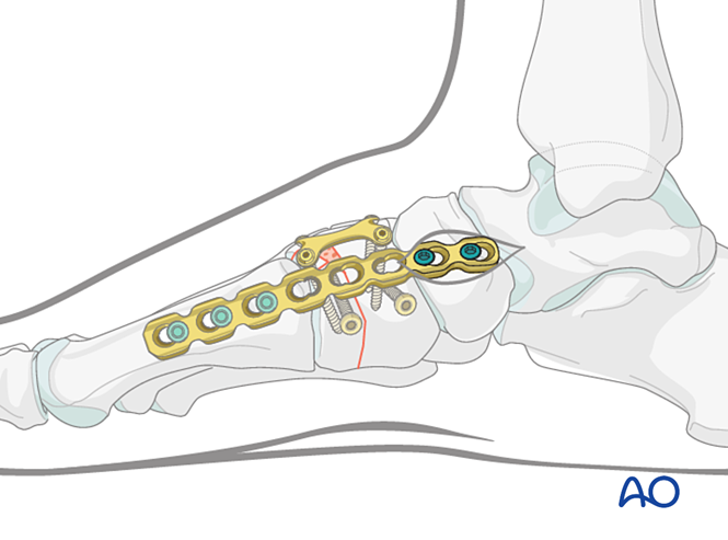 Plate fixation for Cuneiform fracture