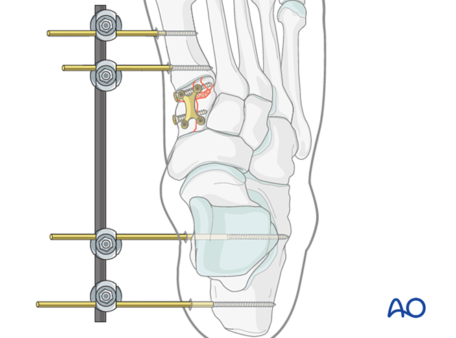Plate fixation for Cuneiform fracture