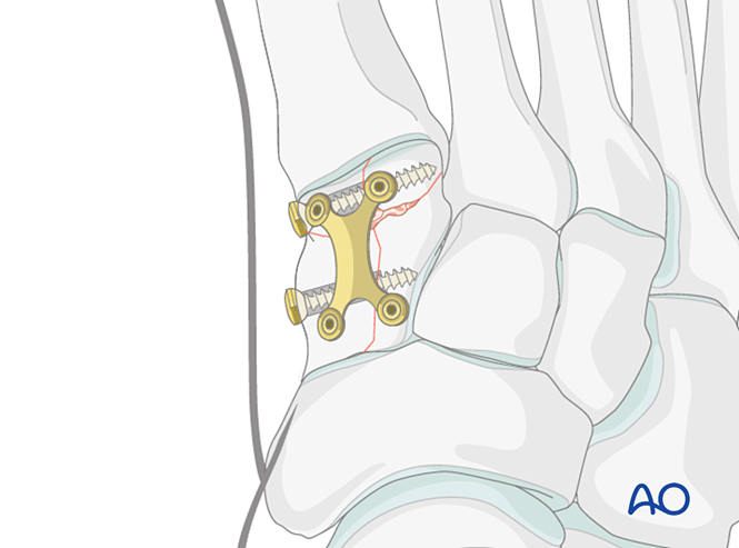 Plate fixation for Cuneiform fracture