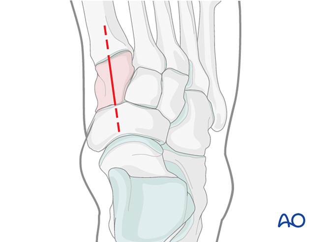 Plate fixation for Cuneiform fracture