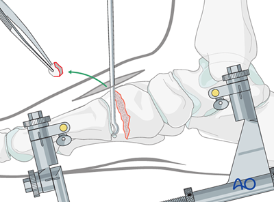 Fusion for Cuneiform fracture