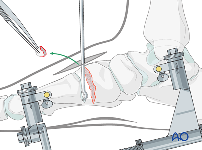 Fusion for Cuneiform fracture