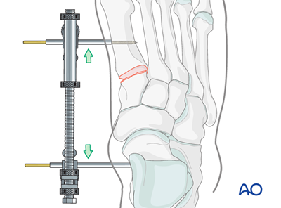 Fusion for Cuneiform fracture