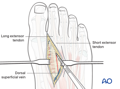 Dorsal approach to multiple metatarsals
