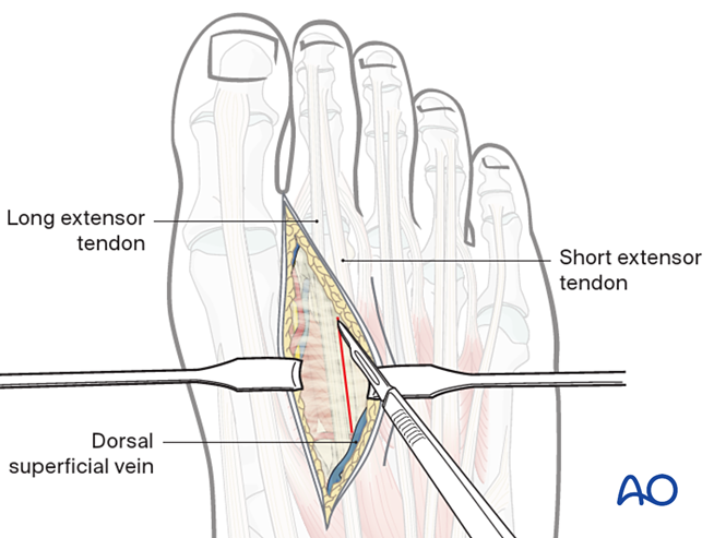 All approaches to the midfoot