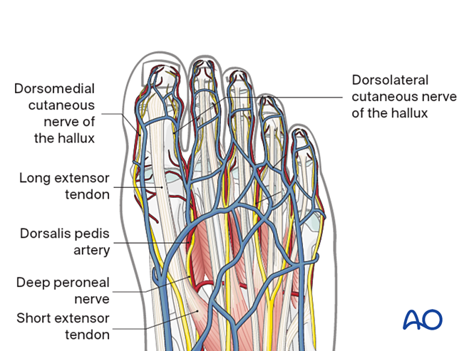 Dorsal approach to the 1st metatarsal