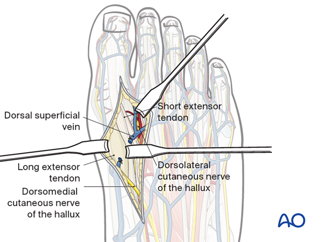 Dorsal approach to the 1st metatarsal