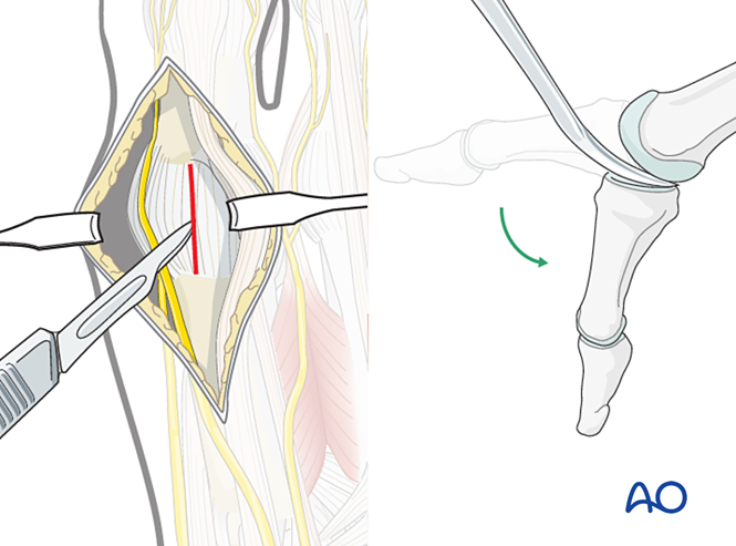 Dorsal approach to the 1st metatarsal