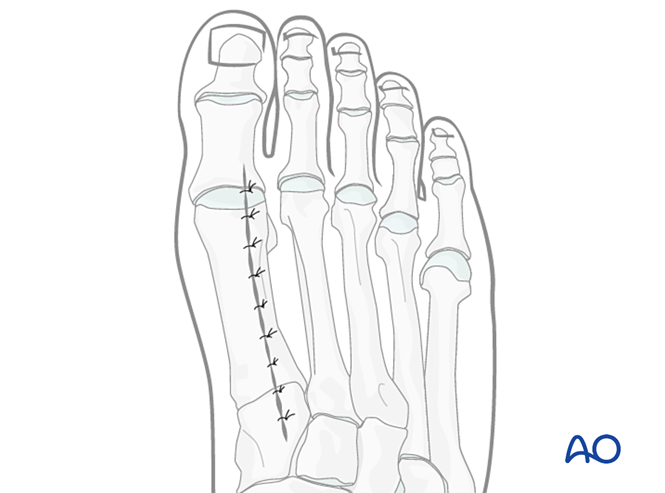 Dorsal approach to the 1st metatarsal