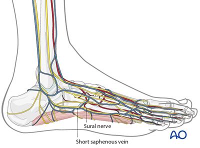 Lateral approach to the 5th metatarsal