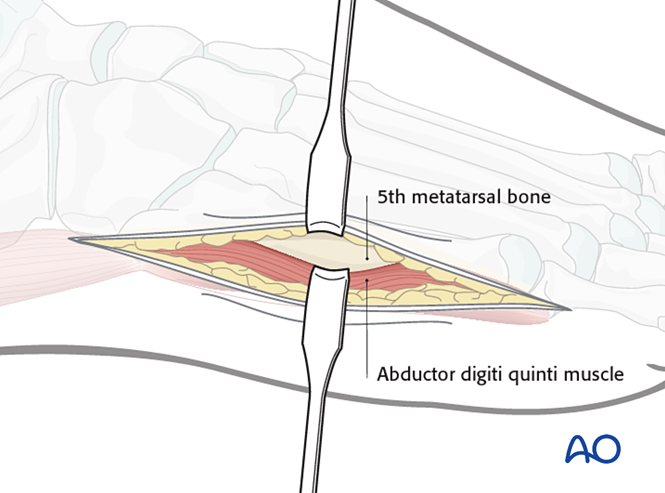 Lateral approach to the 5th metatarsal