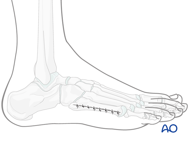 Lateral approach to the 5th metatarsal