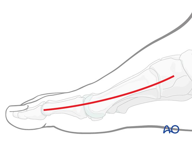 Medial approach to the 1st metatarsal
