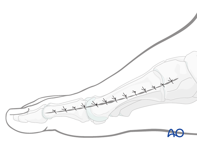 Medial approach to the 1st metatarsal