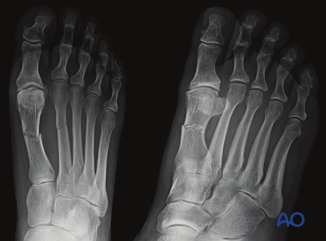 Simple diaphyseal and proximal extraarticular fractures of the 1st to ...