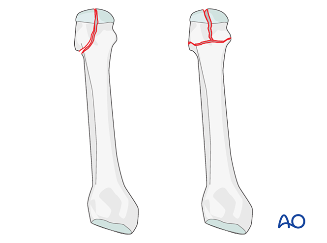 Distal articular fractures of the 1st to 4th metatarsal
