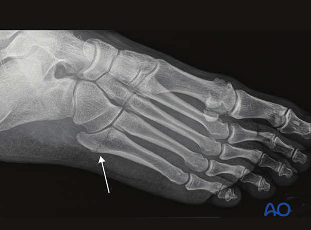 5th Metatarsal Jones Fracture